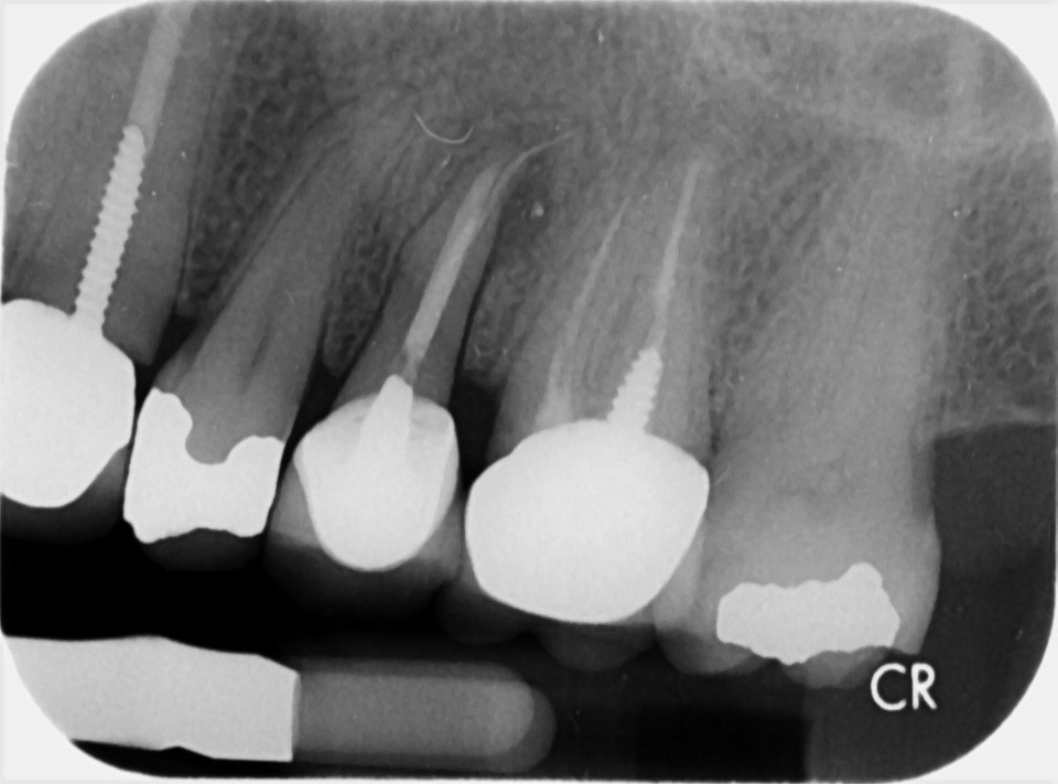 Buccal root of the bifurcated maxillary premolar—a danger zone during ...